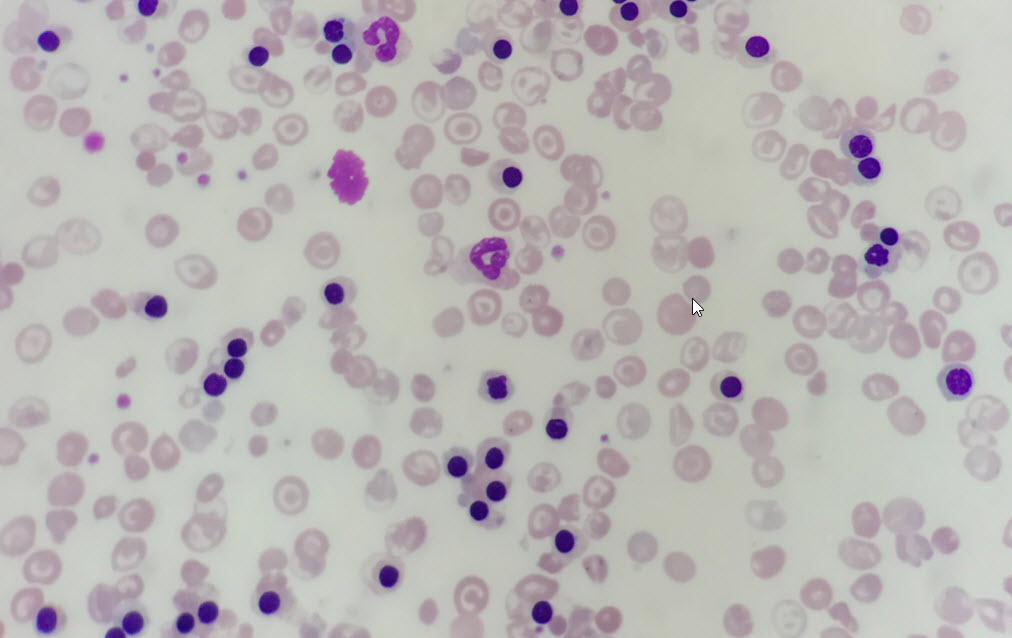 ß Thalassaemia - LearnHaem | Haematology Made Simple