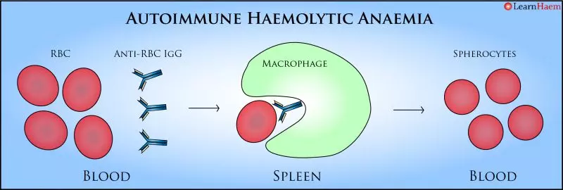 Autoimmune Haemolytic Anaemia - LearnHaem | Haematology Made Simple