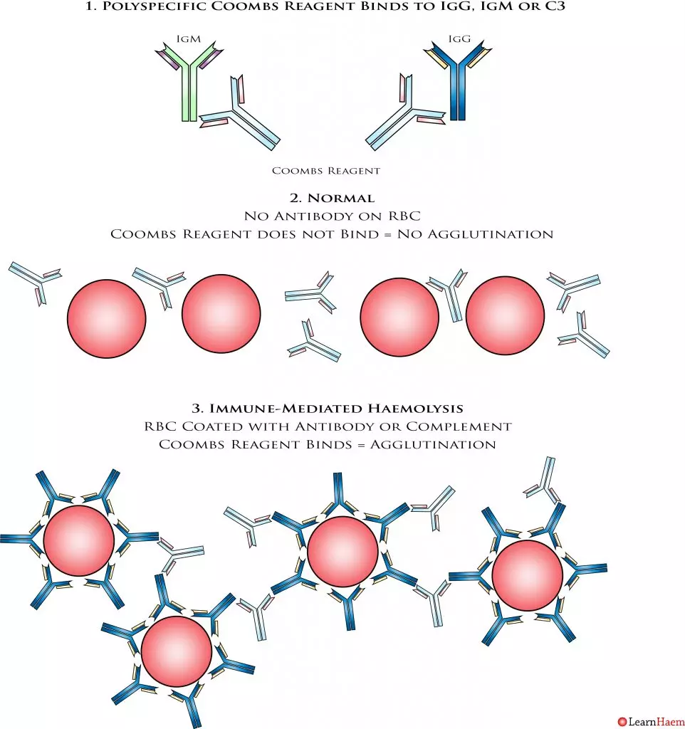 Direct Coombs Test - LearnHaem | Haematology Made Simple