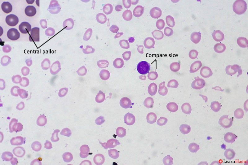 Clinical and Laboratory Features - LearnHaem | Haematology Made Simple
