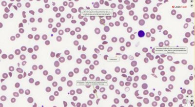 Approach to Haemolysis - LearnHaem | Haematology Made Simple