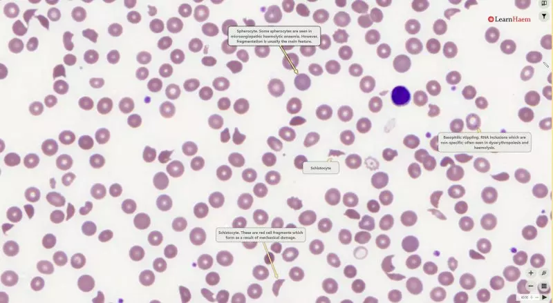 Approach to Haemolysis - LearnHaem | Haematology Made Simple