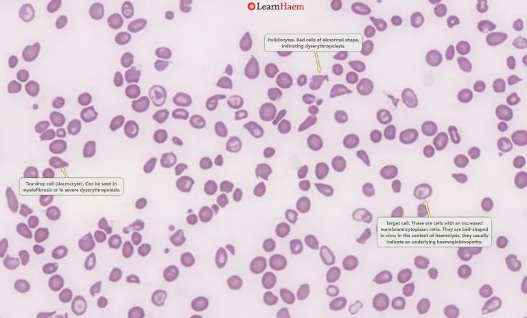 α Thalassaemia - LearnHaem | Haematology Made Simple