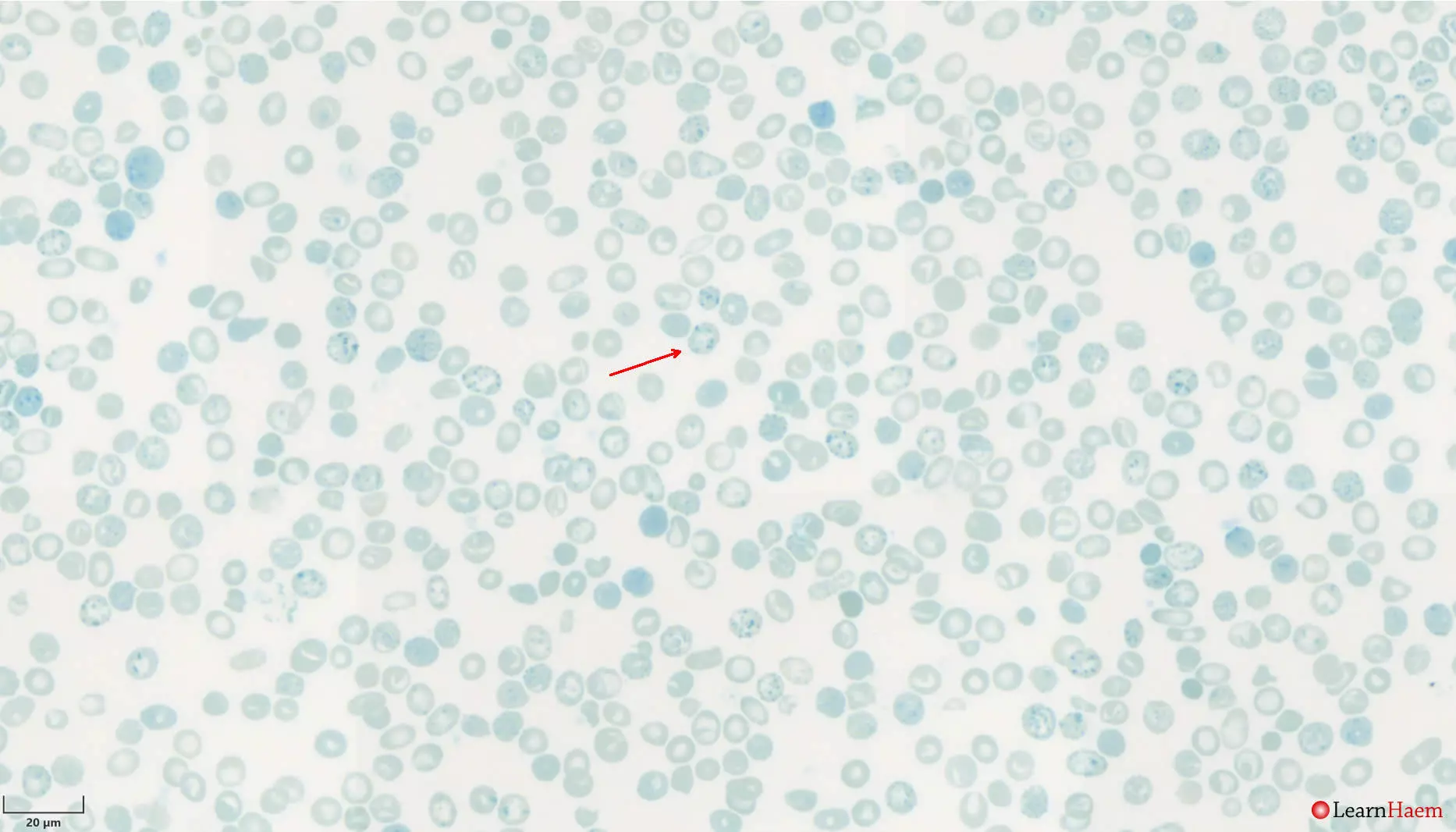 α Thalassaemia - LearnHaem | Haematology Made Simple