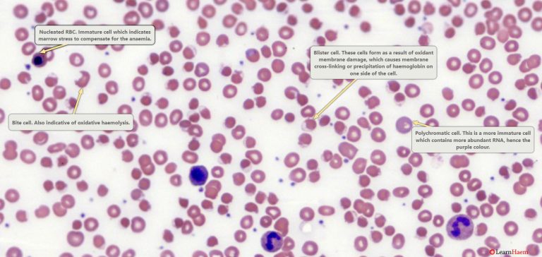 Approach to Haemolysis - LearnHaem | Haematology Made Simple