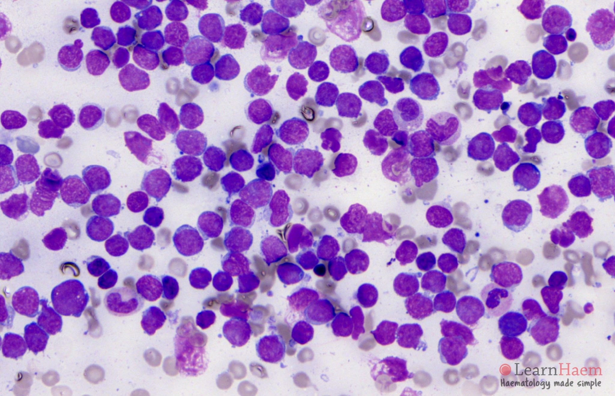 Acute Lymphoblastic Leukaemia LearnHaem Haematology Made Simple
