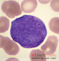Acute Promyelocytic Leukaemia (APML) - LearnHaem | Haematology Made Simple