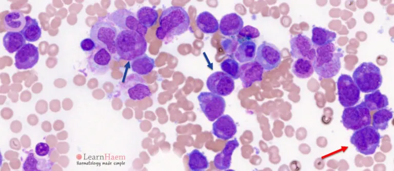 Acute Promyelocytic Leukaemia (APML) - LearnHaem | Haematology Made Simple