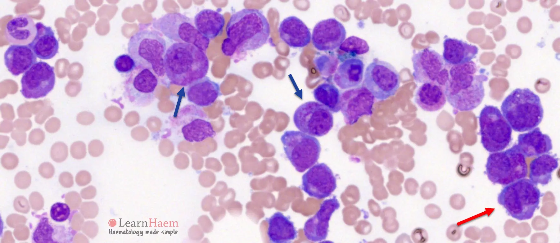 Acute Promyelocytic Leukaemia (APML) - LearnHaem | Haematology Made Simple