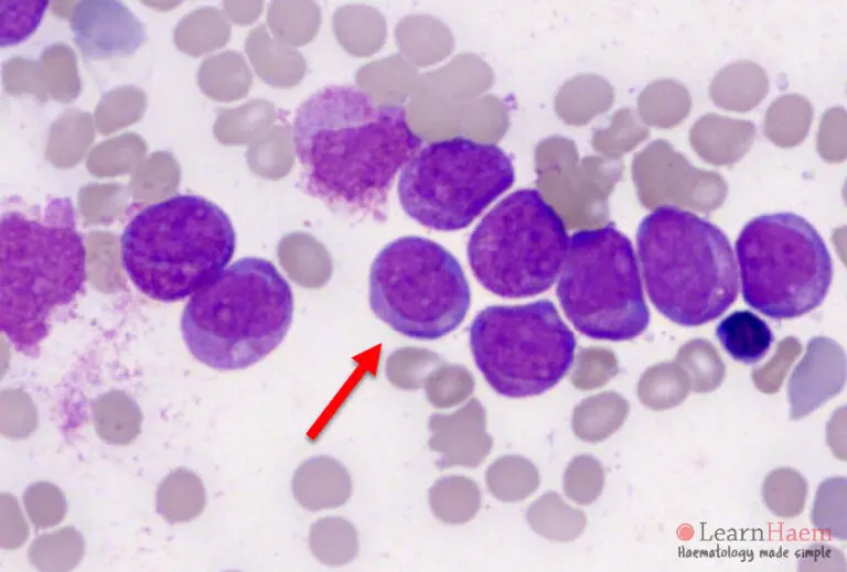 Acute Promyelocytic Leukaemia (APML) - LearnHaem | Haematology Made Simple