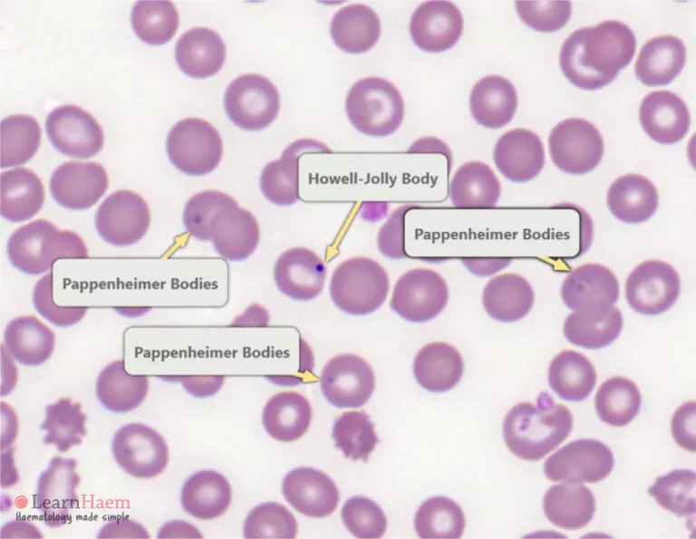 Howell-Jolly Bodies - LearnHaem | Haematology Made Simple