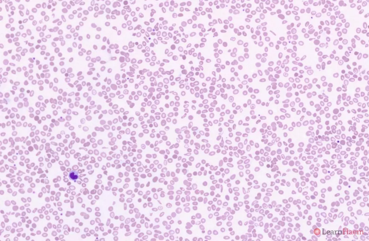 Haemoglobin H-Constant Spring Disease - LearnHaem | Haematology Made Simple
