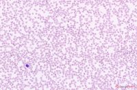 Haemoglobin H (HbH) Disease - LearnHaem | Haematology Made Simple