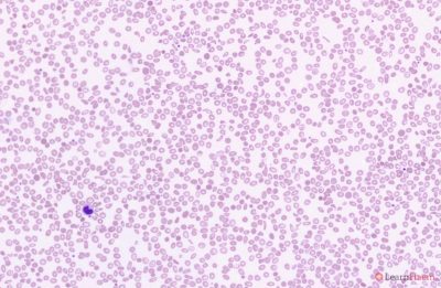 Haemoglobin H (HbH) Disease - LearnHaem | Haematology Made Simple