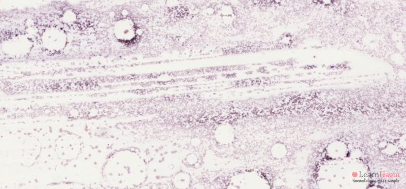 Hypoplastic MDS - LearnHaem | Haematology Made Simple