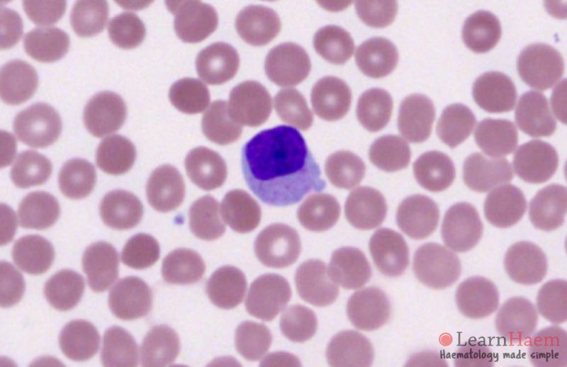 Reactive Lymphocytes / Benign Disorders - LearnHaem | Haematology Made ...