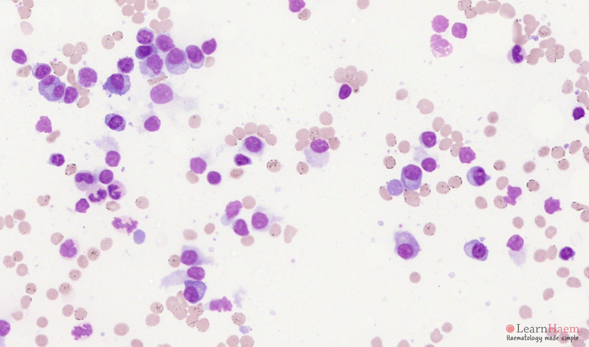 Lymphoplasmacytic Lymphoma - LearnHaem | Haematology Made Simple