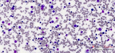 MDS with Excess Blasts - LearnHaem | Haematology Made Simple