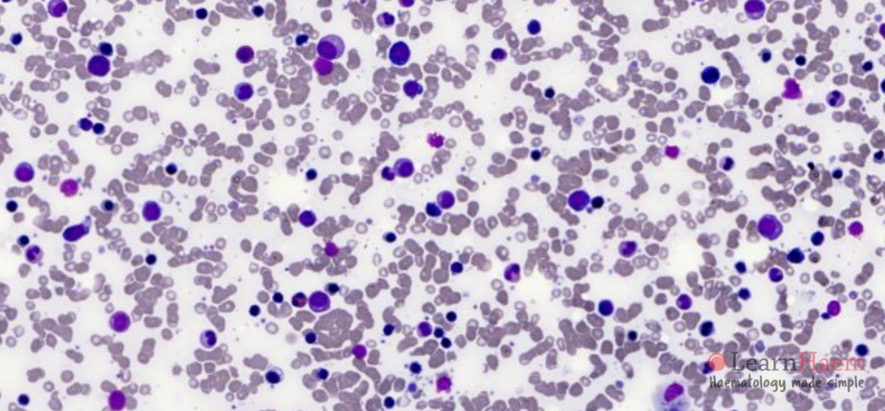 MDS Overview - LearnHaem | Haematology Made Simple