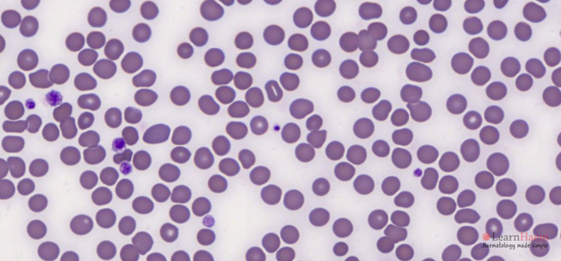 Macrothrombocytopaenia - LearnHaem | Haematology Made Simple