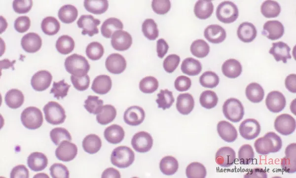 Acanthocytes - LearnHaem | Haematology Made Simple