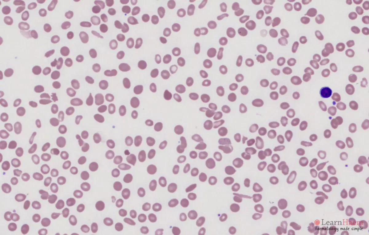 Anisopoikilocytosis - LearnHaem | Haematology Made Simple