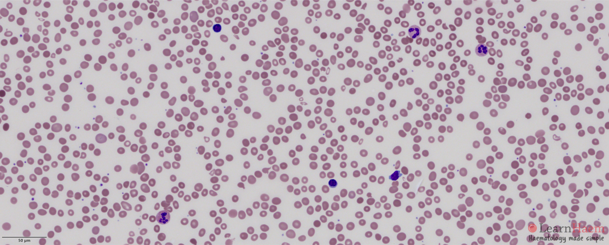 B12 Deficiency / Megaloblastic Anaemia - LearnHaem | Haematology Made ...