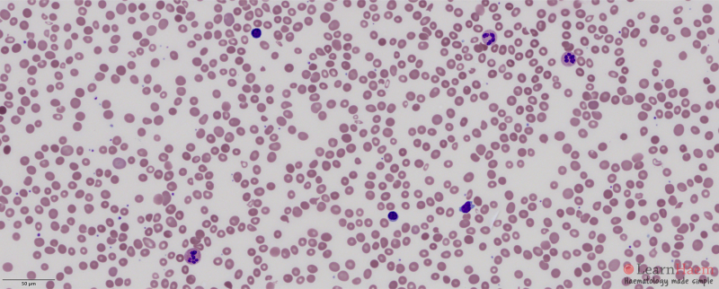 B12 Deficiency / Megaloblastic Anaemia - LearnHaem | Haematology Made ...