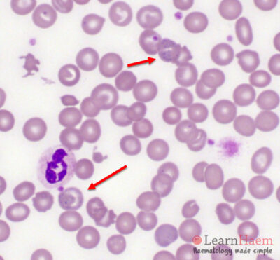 Basophilic Stippling - LearnHaem | Haematology Made Simple