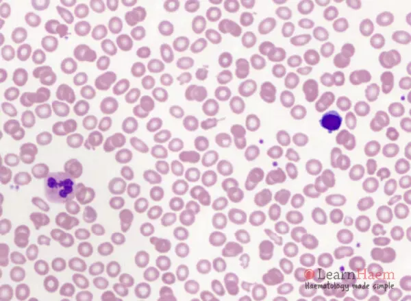 Microcytosis - LearnHaem | Haematology Made Simple