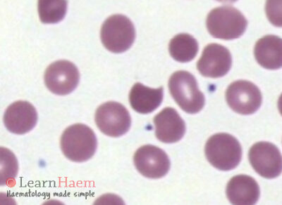 Bite Cells / Blister Cells - LearnHaem | Haematology Made Simple