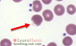 Bite Cells / Blister Cells - LearnHaem | Haematology Made Simple