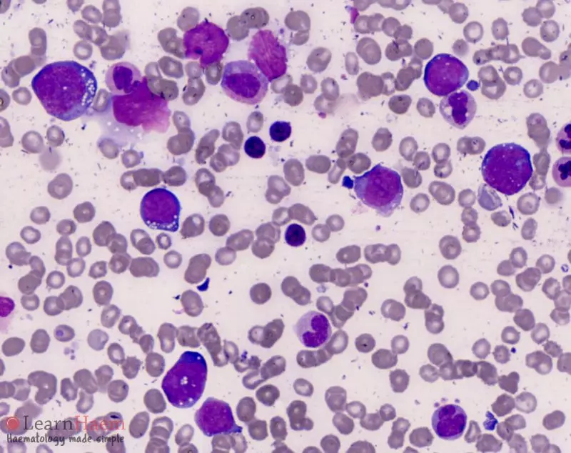 Burkitt Lymphoma - LearnHaem | Haematology Made Simple