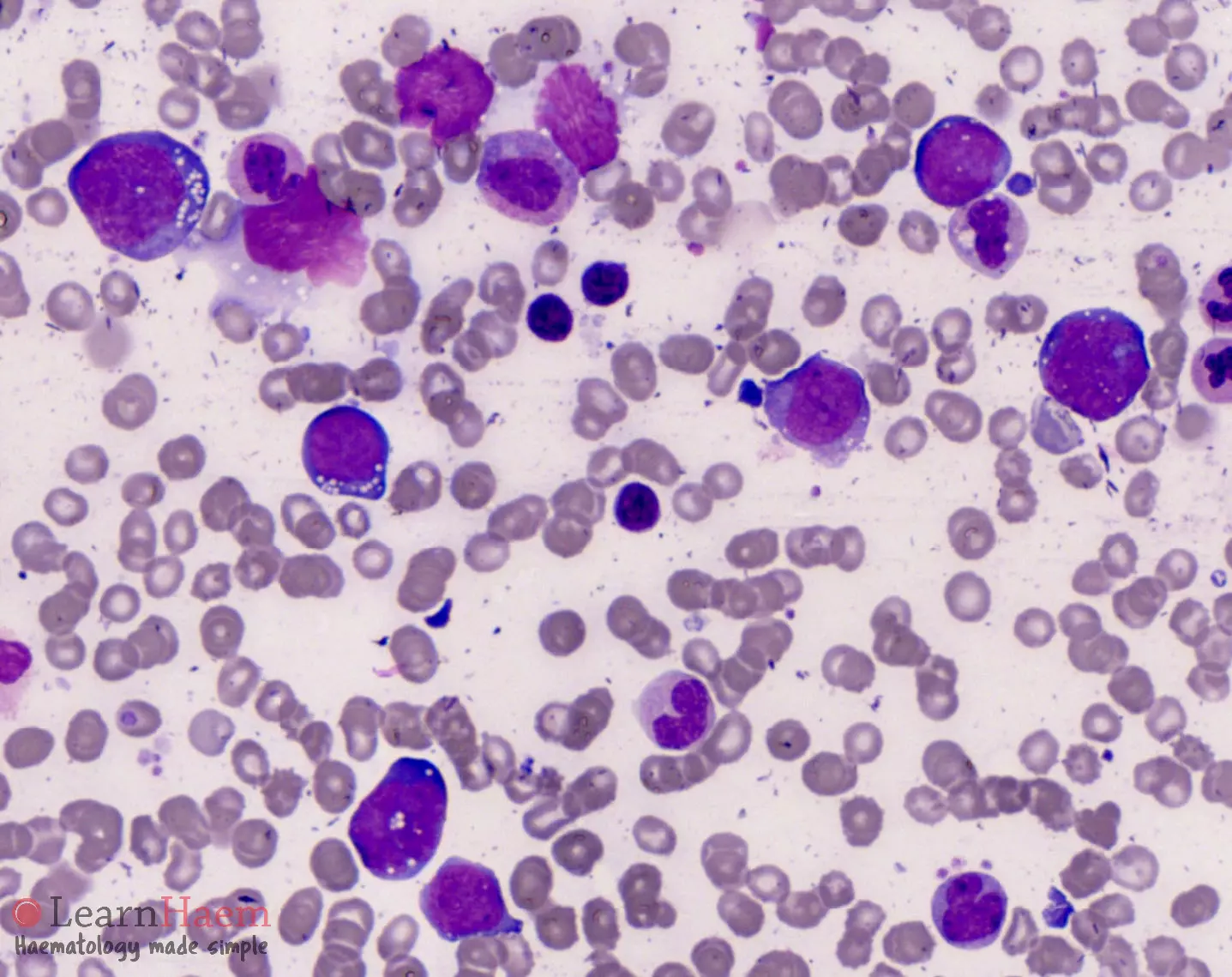 Burkitt Lymphoma - LearnHaem | Haematology Made Simple