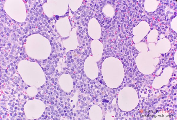 Burkitt Lymphoma - LearnHaem | Haematology Made Simple