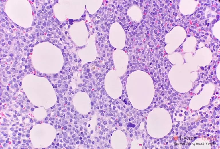 Burkitt Lymphoma - LearnHaem | Haematology Made Simple
