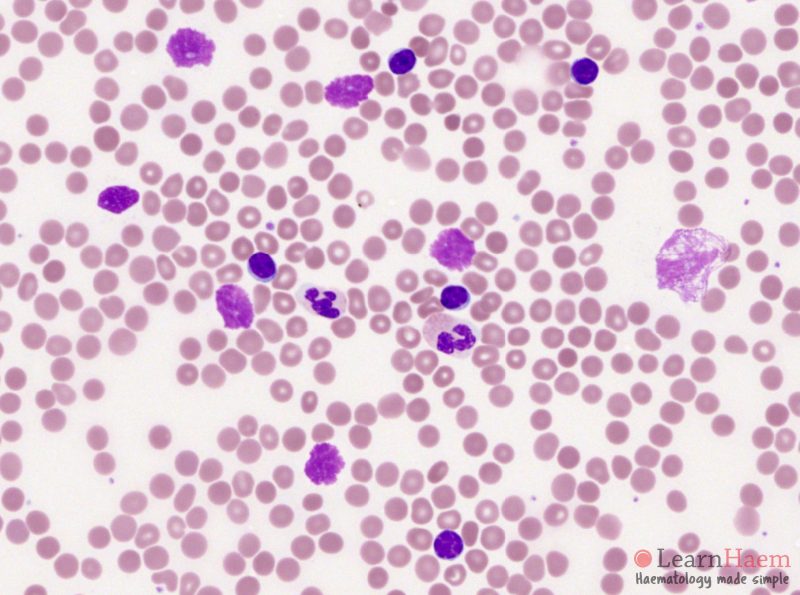 Chronic Lymphocytic Leukaemia - LearnHaem | Haematology Made Simple