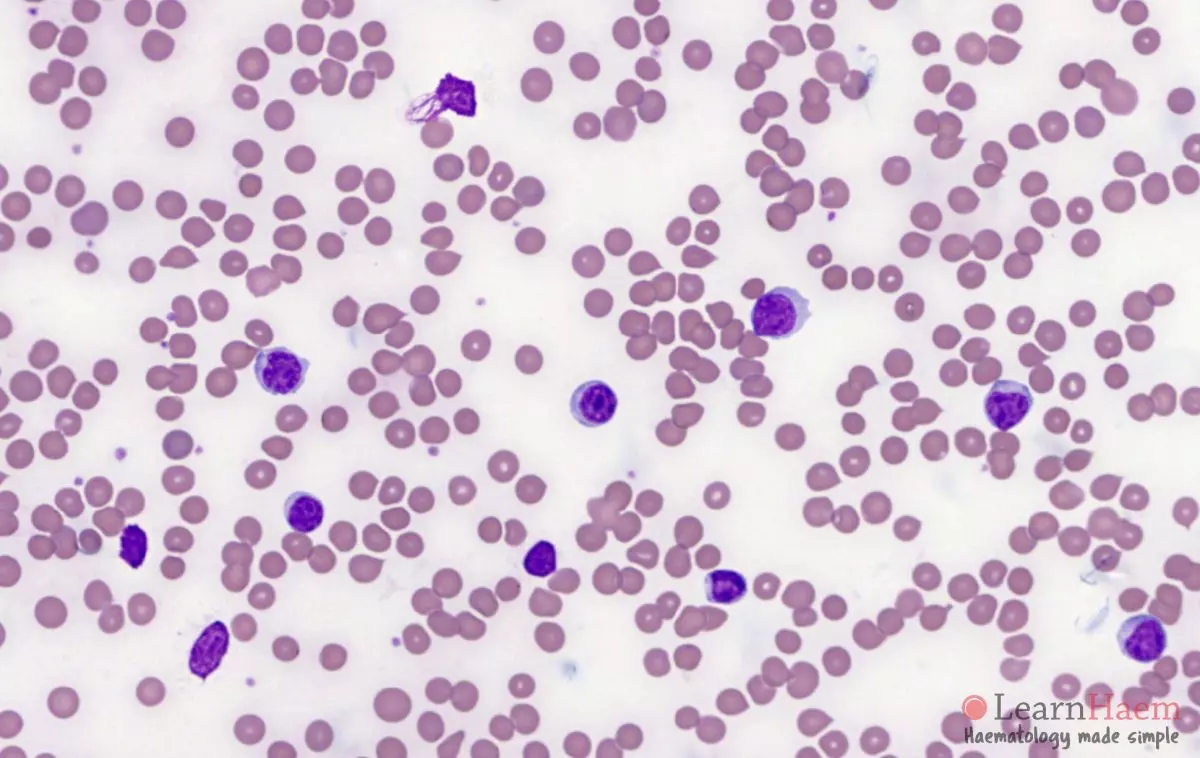Chronic Lymphocytic Leukaemia - LearnHaem | Haematology Made Simple