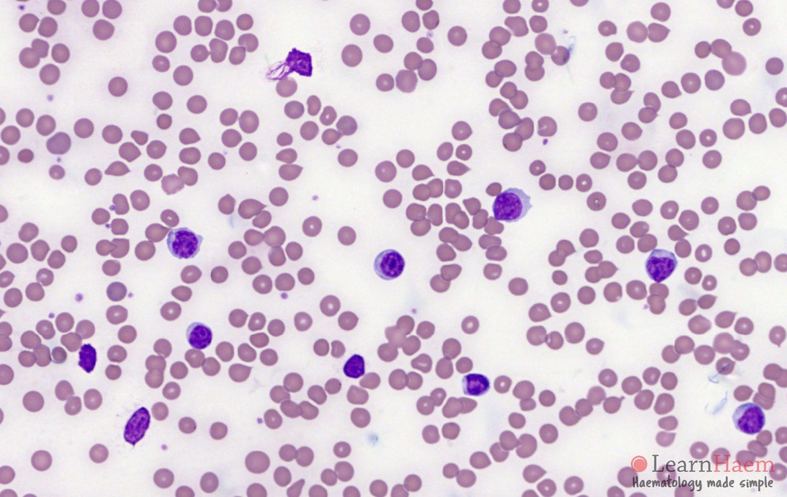 Chronic Lymphocytic Leukaemia - LearnHaem | Haematology Made Simple
