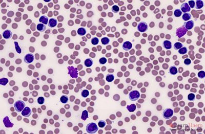Chronic Lymphocytic Leukaemia - LearnHaem | Haematology Made Simple