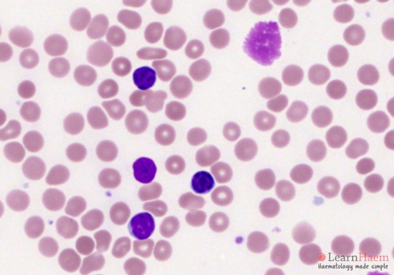 Chronic Lymphocytic Leukaemia - LearnHaem | Haematology Made Simple