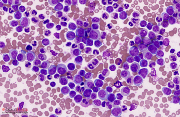 CML in Blast Phase - LearnHaem | Haematology Made Simple