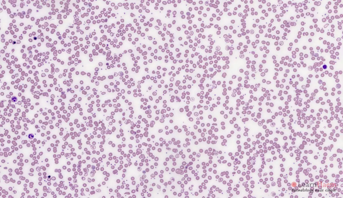 Dimorphic Picture - LearnHaem | Haematology Made Simple