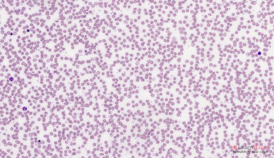 Dimorphic Picture - LearnHaem | Haematology Made Simple