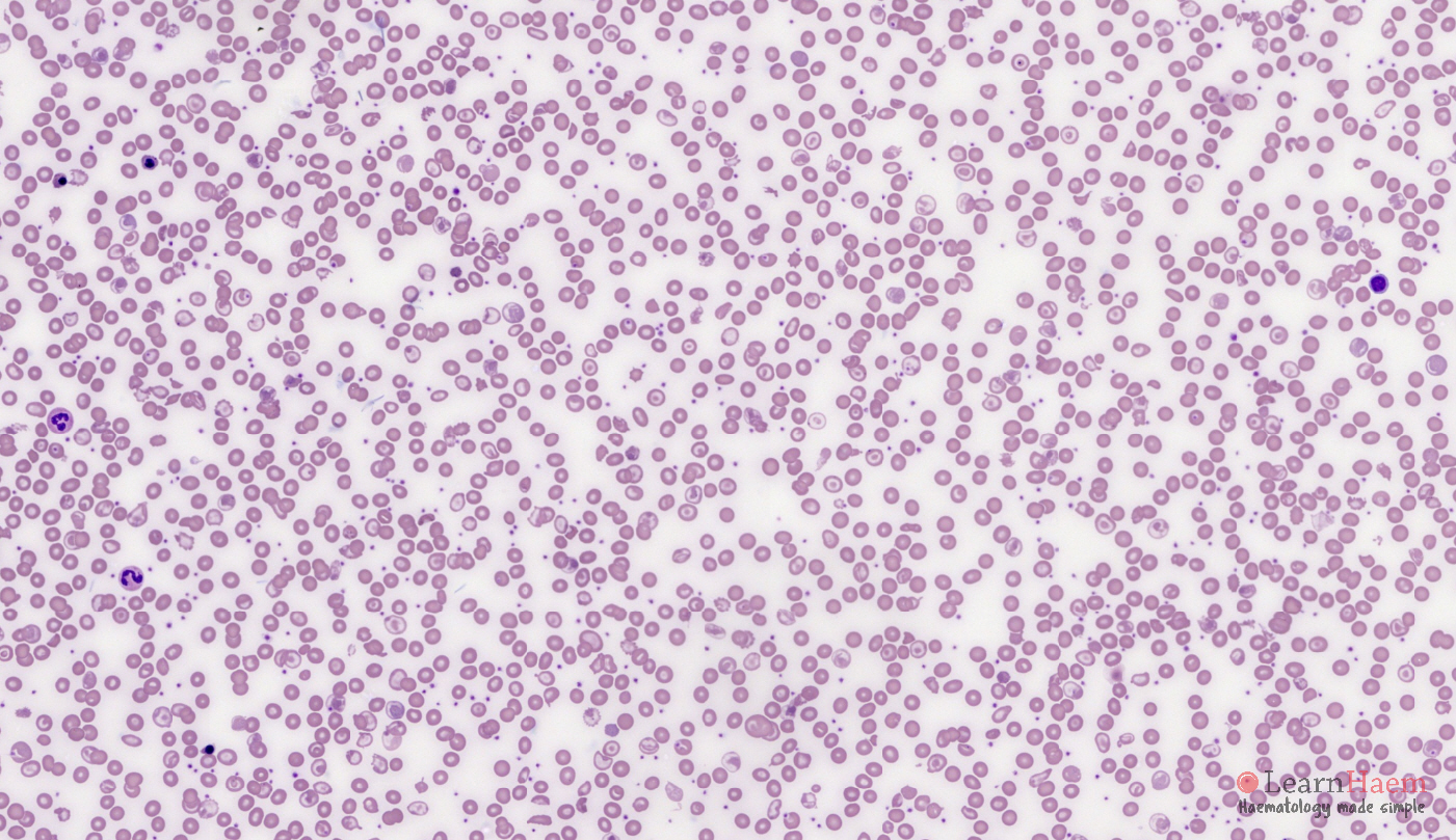 Dimorphic Picture - LearnHaem | Haematology Made Simple