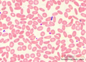 Elliptocytes - LearnHaem | Haematology Made Simple