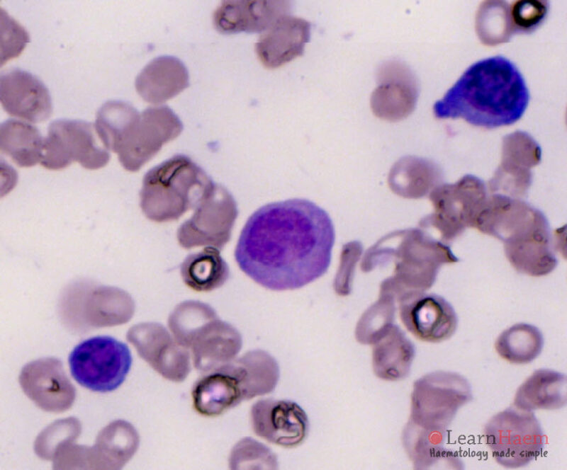 Multiple Myeloma - LearnHaem | Haematology Made Simple