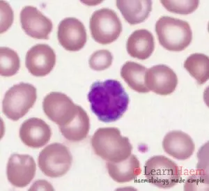 Adult T-Cell Leukaemia/Lymphoma - LearnHaem | Haematology Made Simple