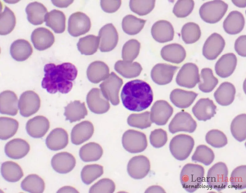 Adult T-Cell Leukaemia/Lymphoma - LearnHaem | Haematology Made Simple