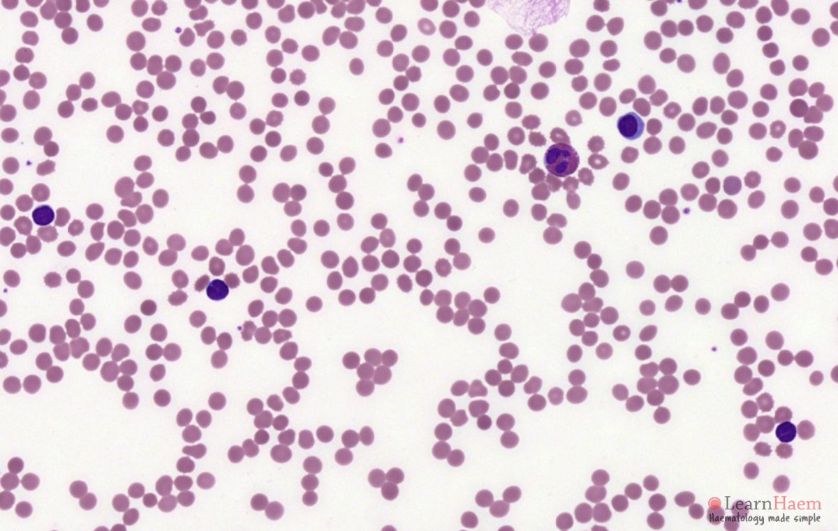 Follicular Lymphoma - LearnHaem | Haematology Made Simple